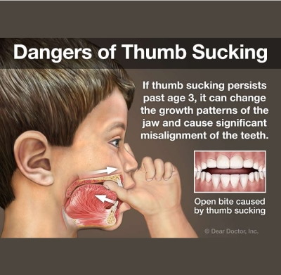 Early Orthodontic Treatment | E.L. Dellinger Orthodontics