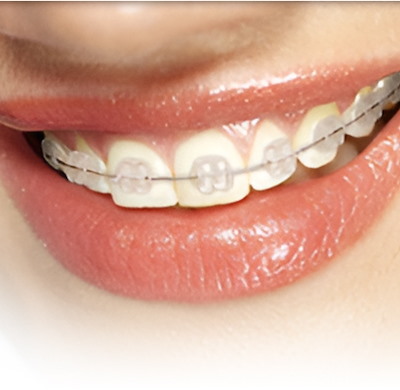 Types of Braces | E.L. Dellinger Orthodontics
