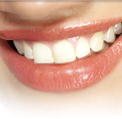 Types of Braces | E.L. Dellinger Orthodontics