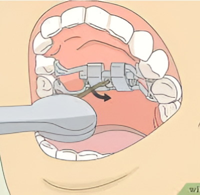 Orthodontic Expanders | E.L. Dellinger Orthodontics