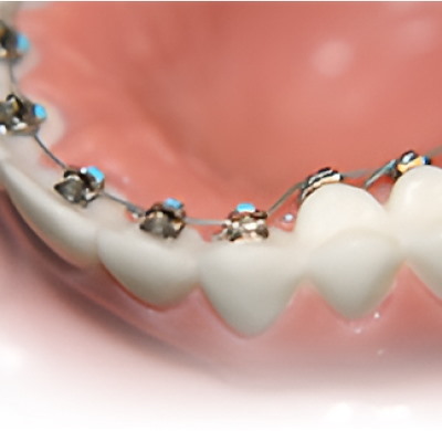 Types of Braces | E.L. Dellinger Orthodontics